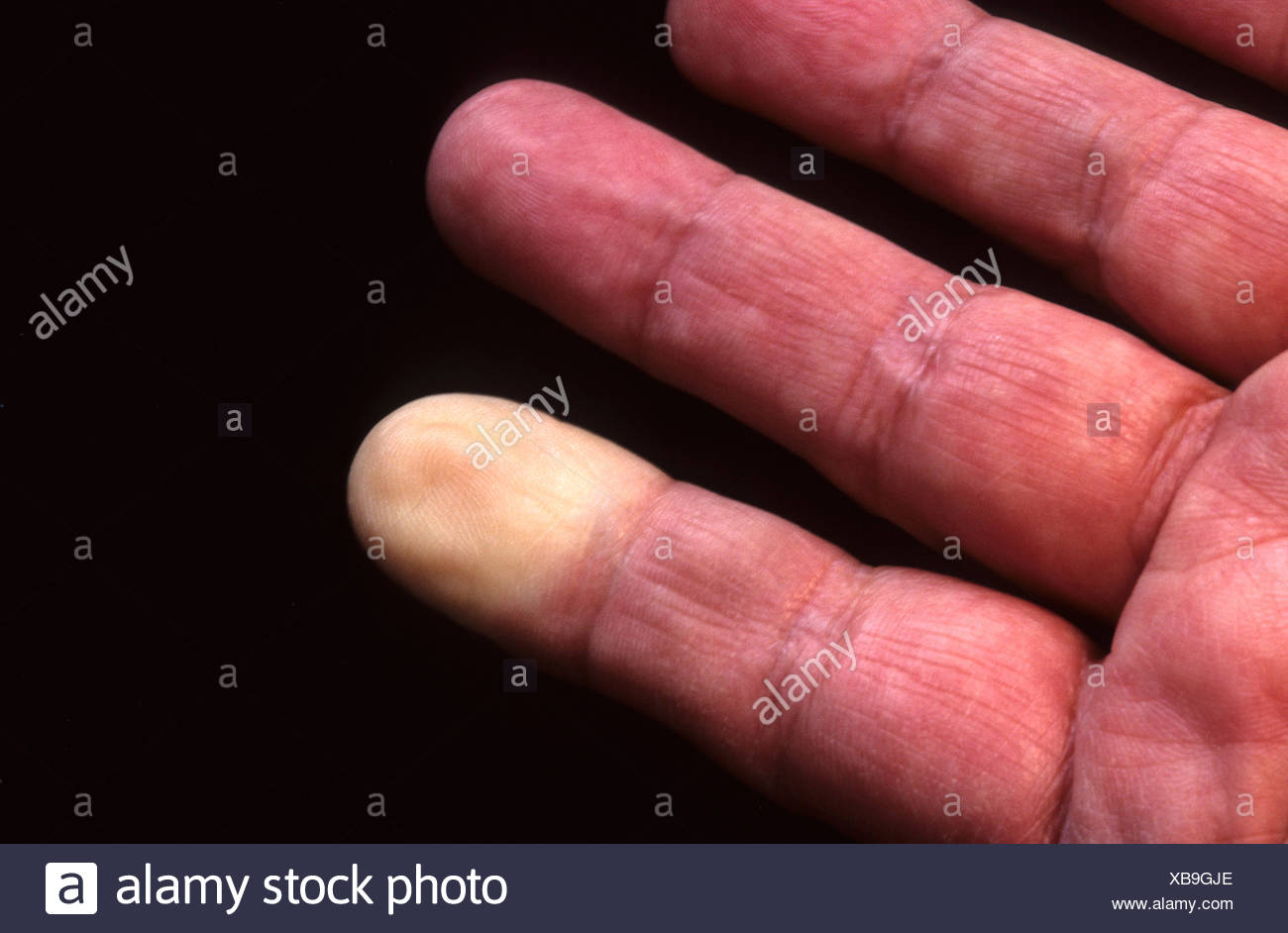 Raynauds Stock Photos & Raynauds Stock Images - Alamy