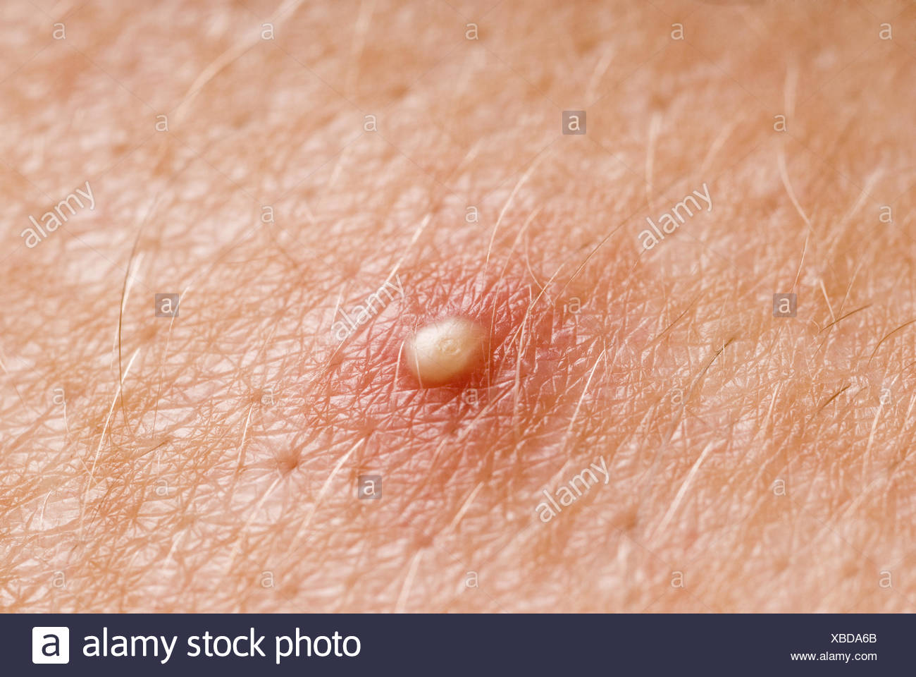 Zit High Resolution Stock Photography and Images - Alamy