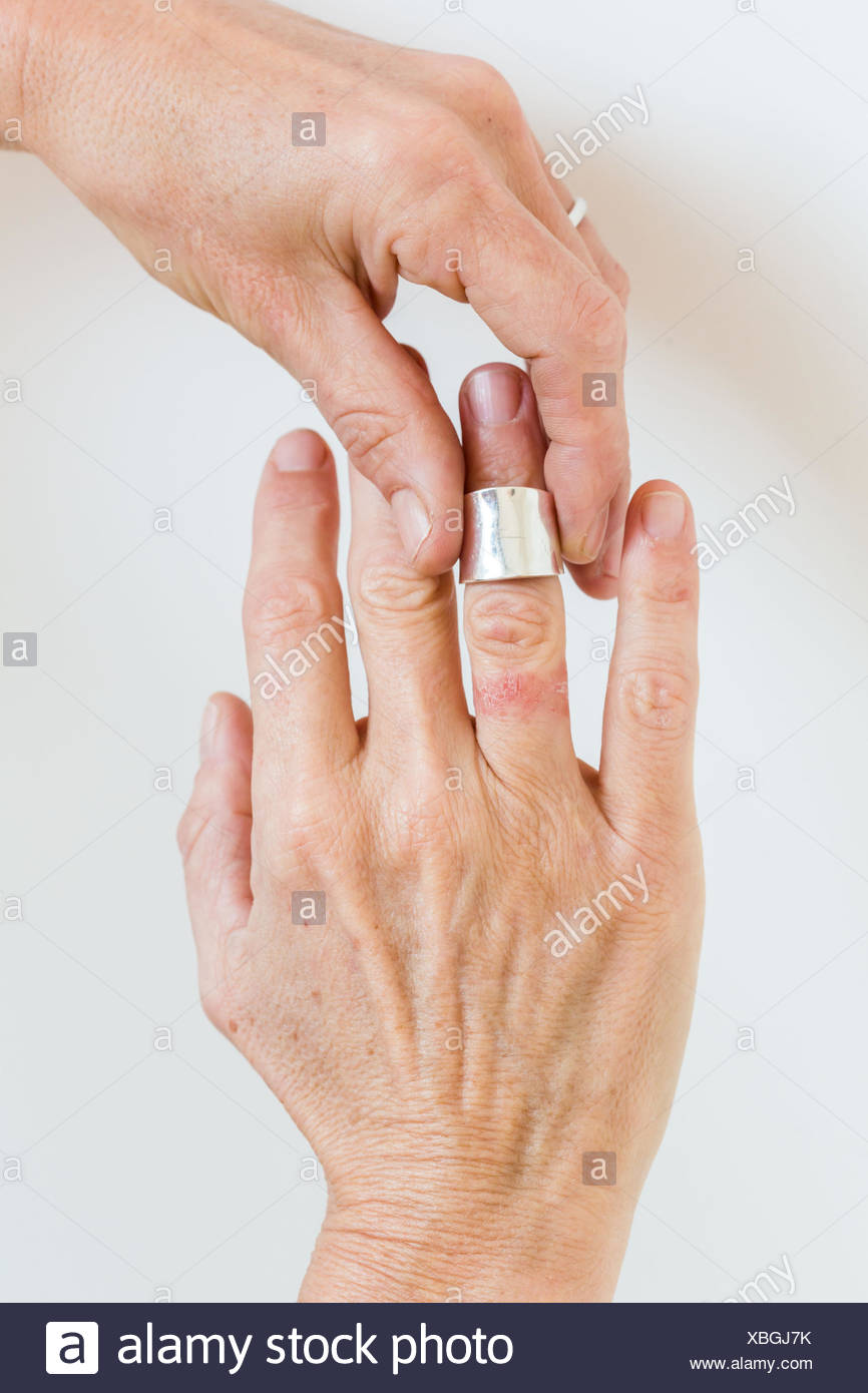 Dermatitis Stock Photos & Dermatitis Stock Images - Alamy