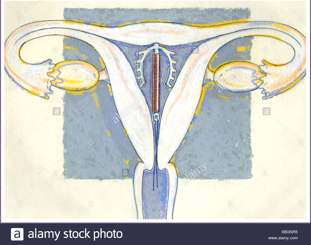 Copper Iud Stock Photos & Copper Iud Stock Images - Alamy