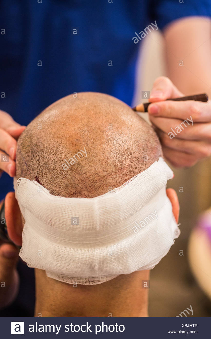 Follicular Unit High Resolution Stock Photography and Images - Alamy