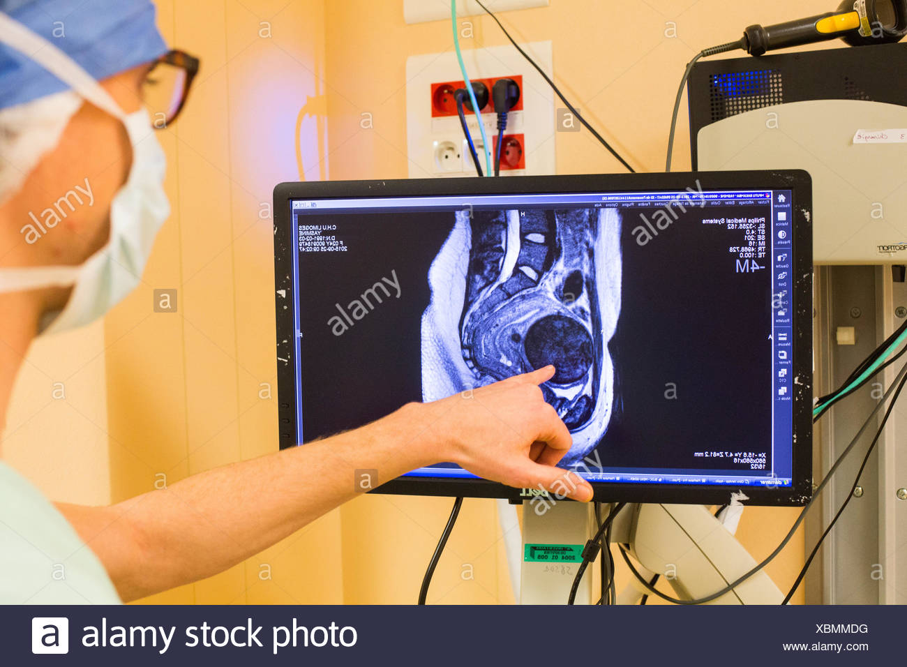 Uterus Fibroma High Resolution Stock Photography and Images - Alamy