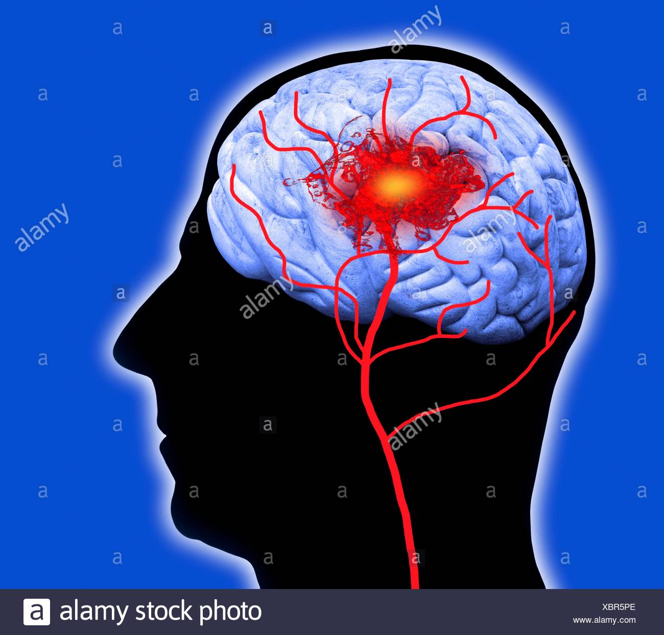 Human Brain Showing Stroke High Resolution Stock Photography and Images ...