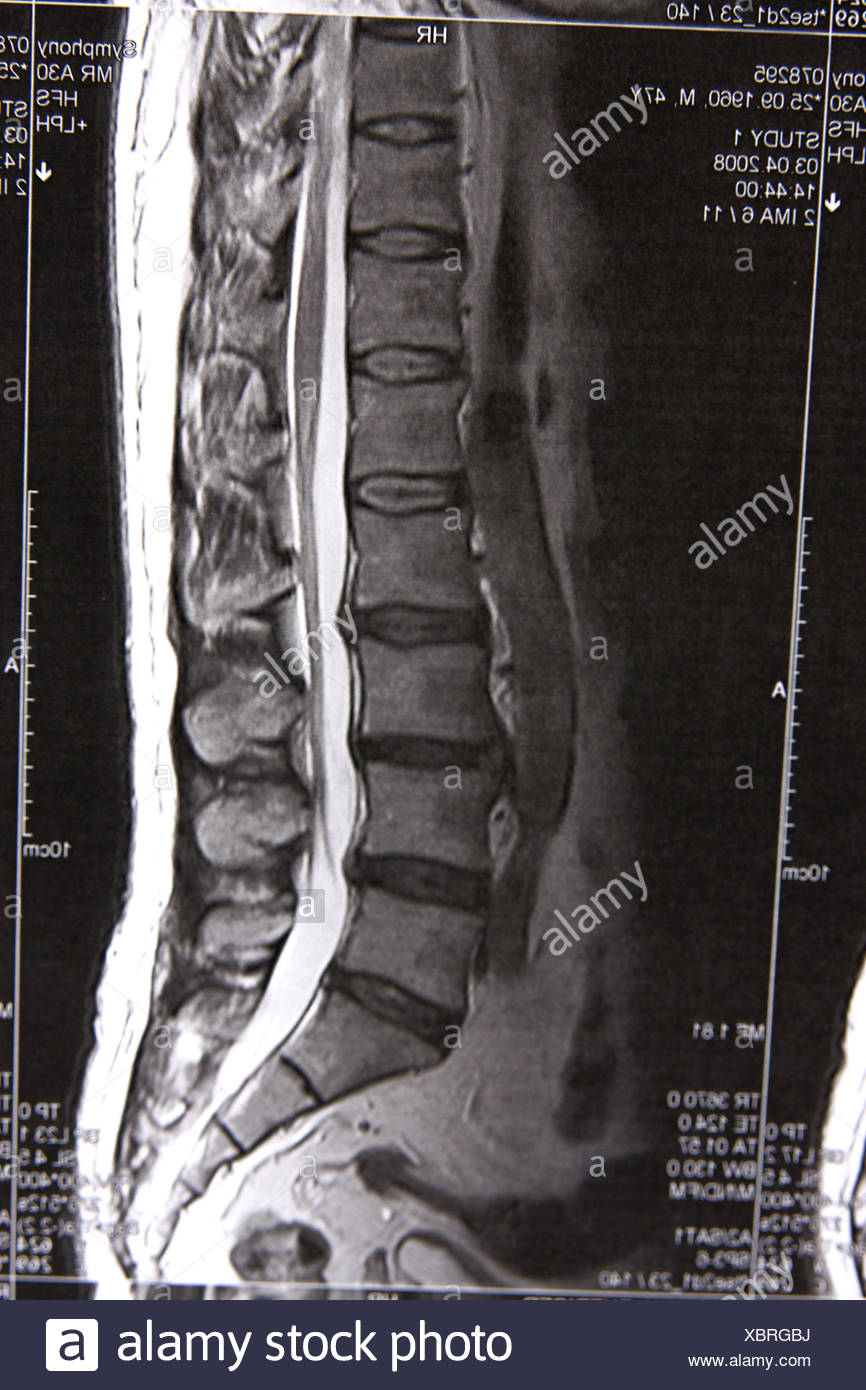 Herniated Lumbar Disc Mri High Resolution Stock Photography and Images ...