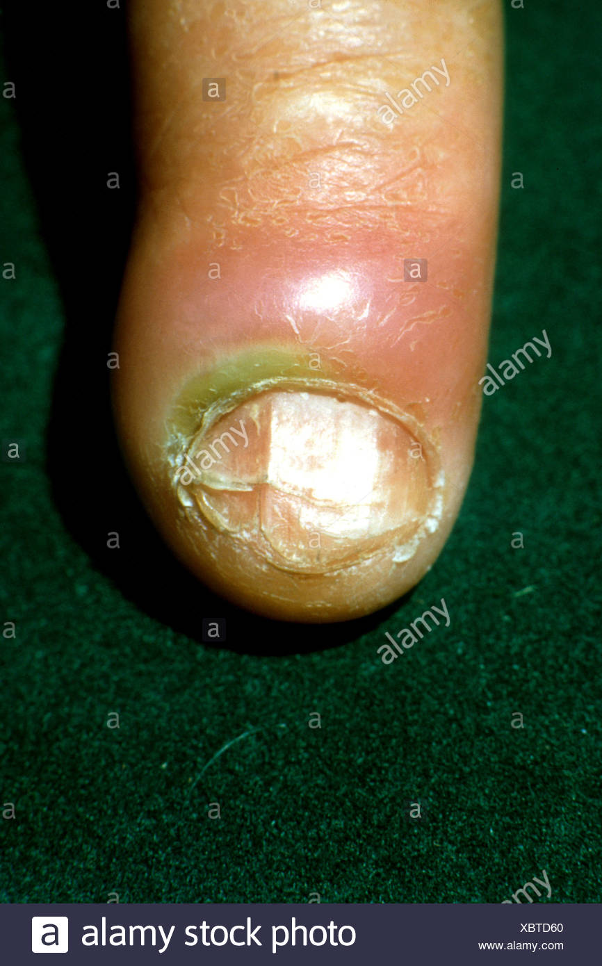 Whitlow High Resolution Stock Photography and Images - Alamy