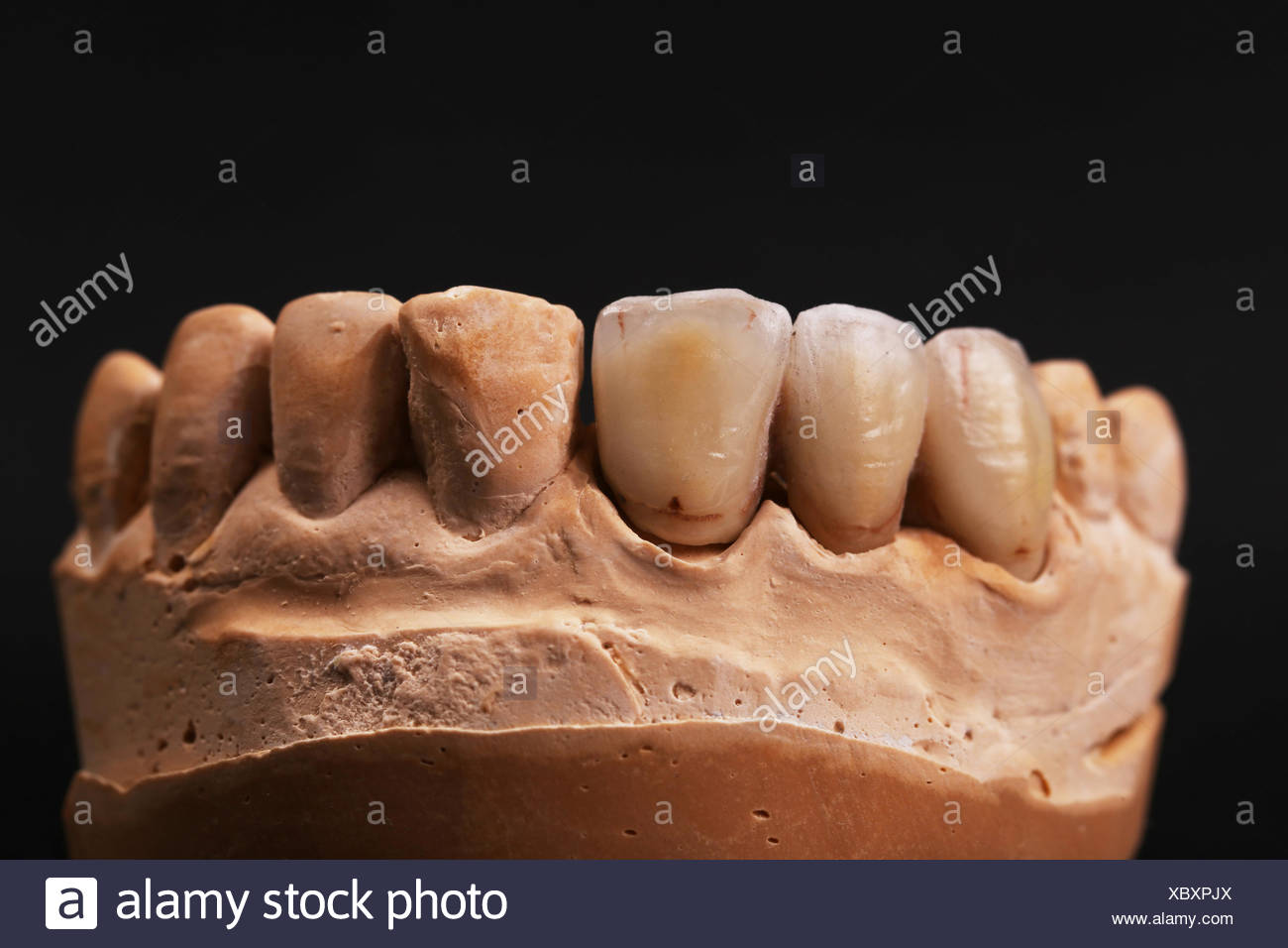 Bone Cast High Resolution Stock Photography and Images - Alamy