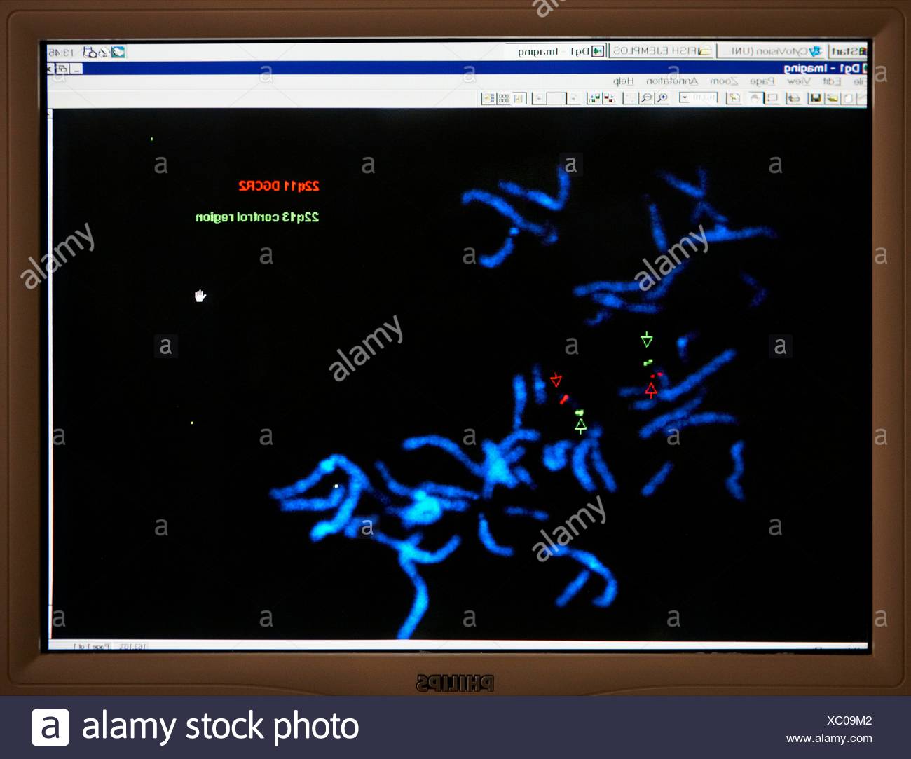 Digeorge High Resolution Stock Photography and Images - Alamy