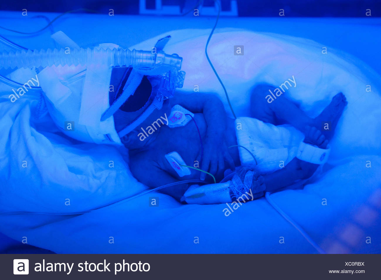 Treatment Of Jaundice High Resolution Stock Photography and Images - Alamy