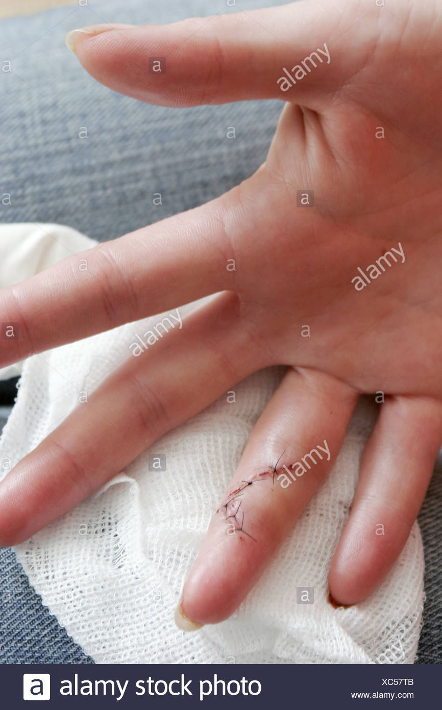 Severed Finger High Resolution Stock Photography and Images - Alamy