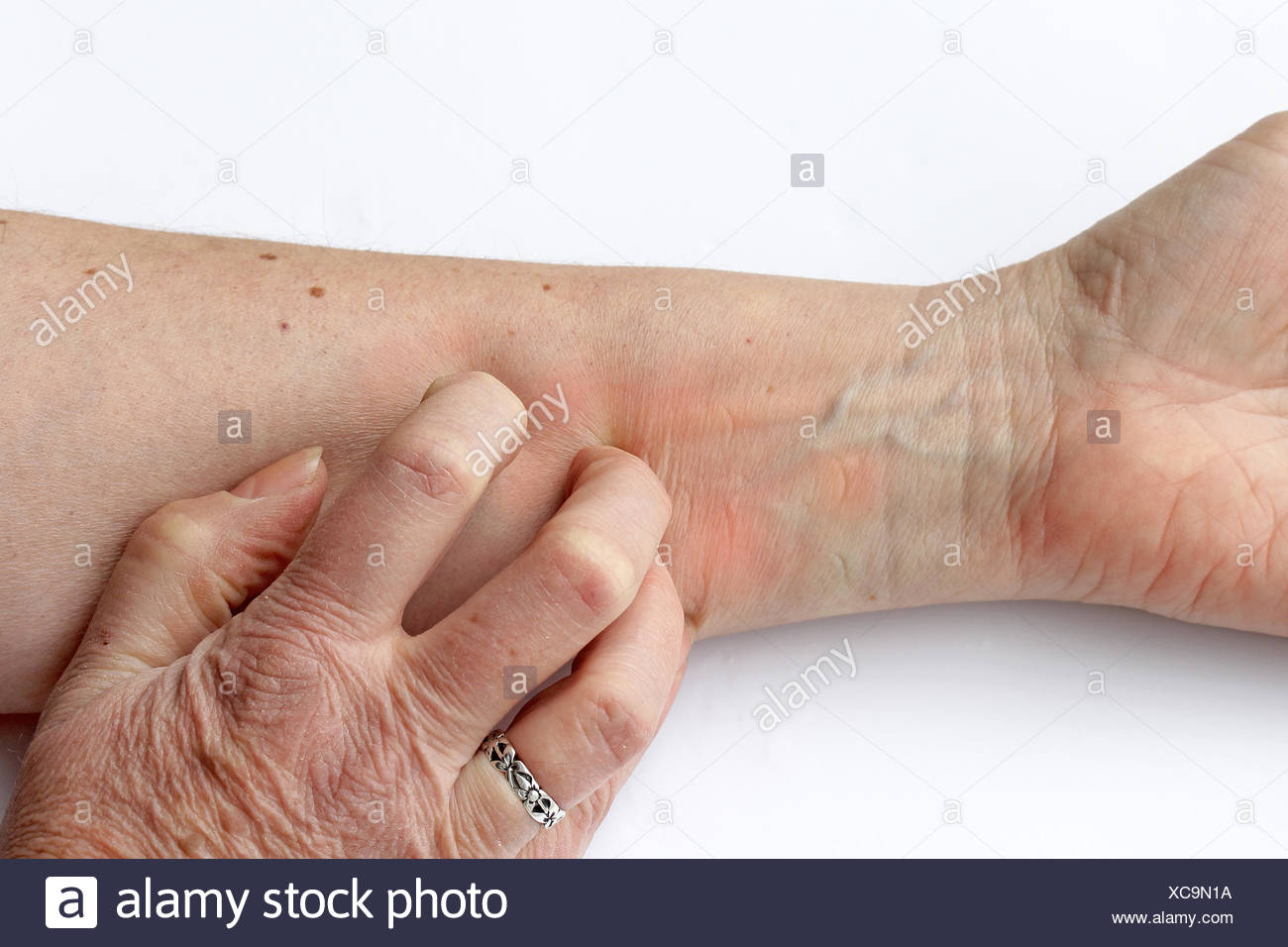 Red Skin Rash High Resolution Stock Photography and Images - Alamy