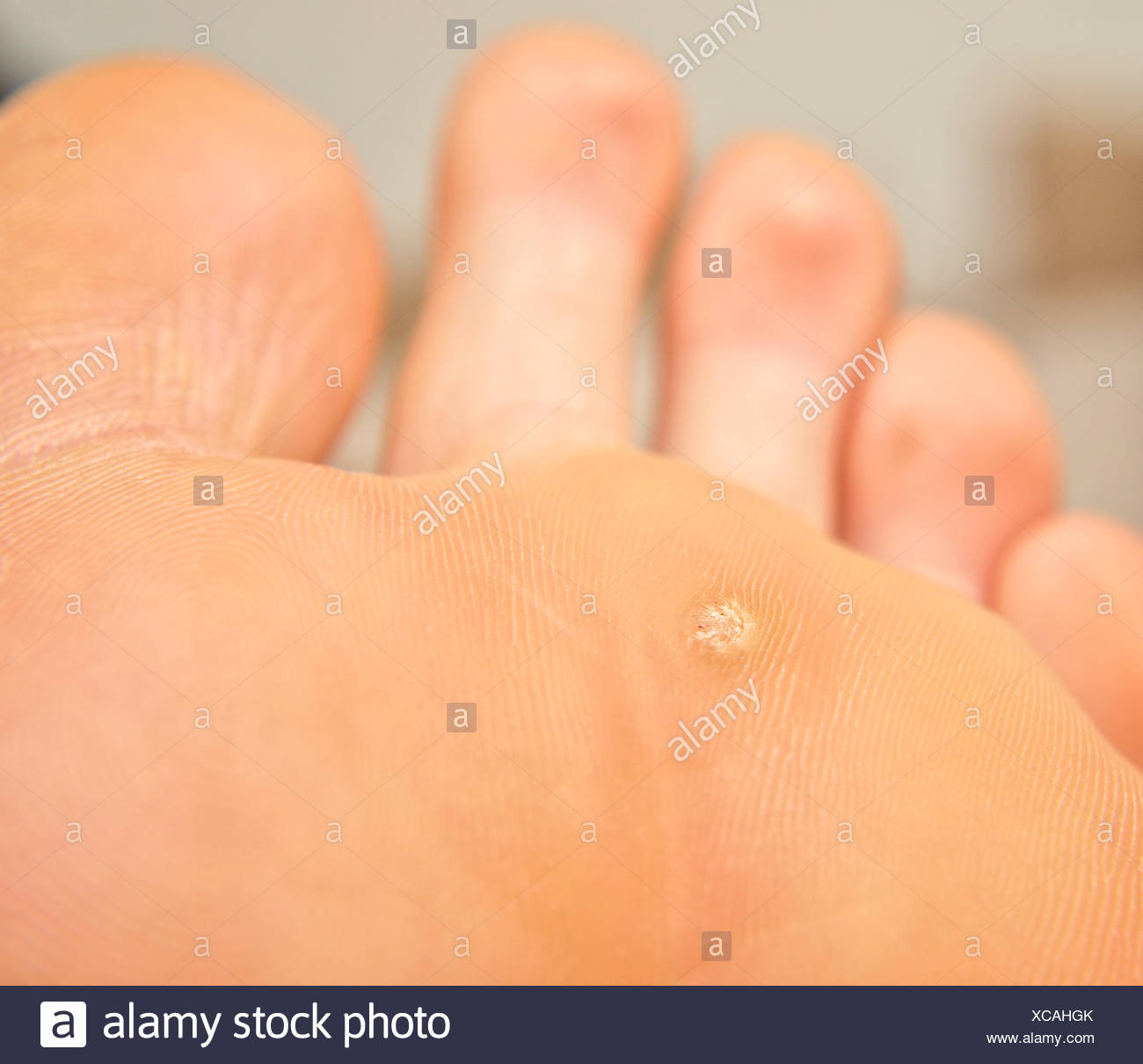 Hyperkeratosis High Resolution Stock Photography and Images - Alamy