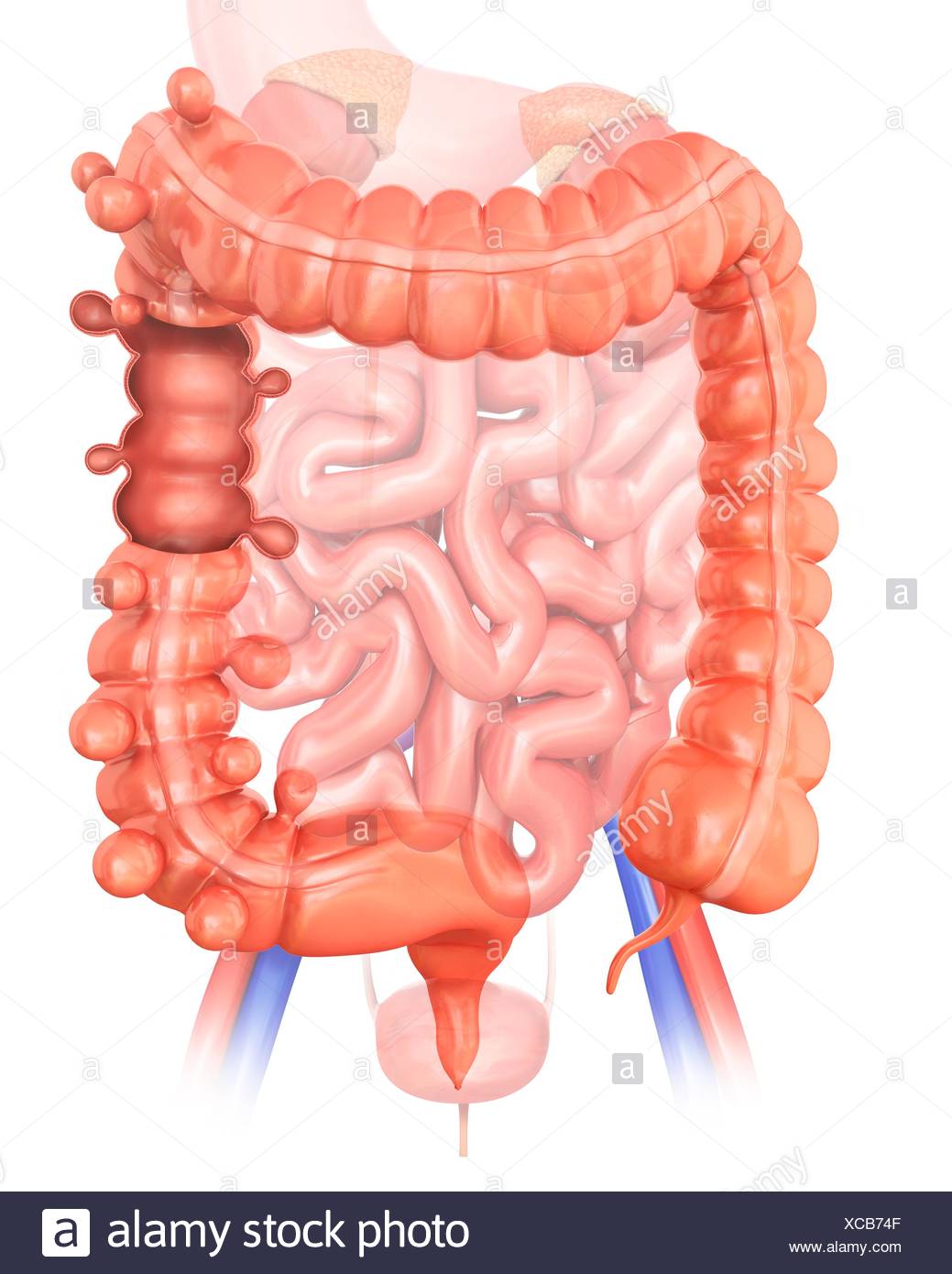 Large Intestine Diverticulitis High Resolution Stock Photography and ...