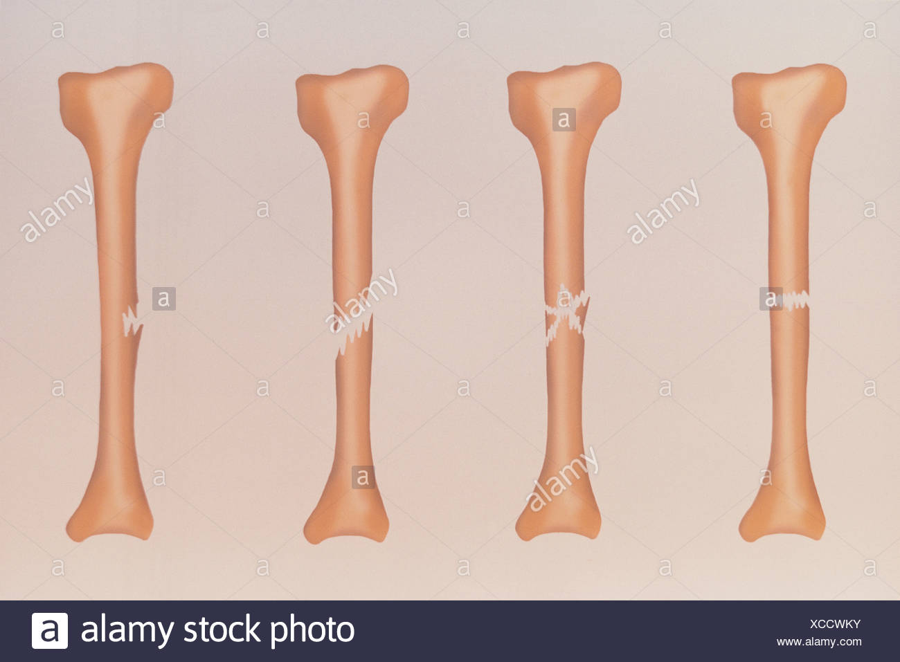 Transverse Bone Fracture High Resolution Stock Photography and Images ...