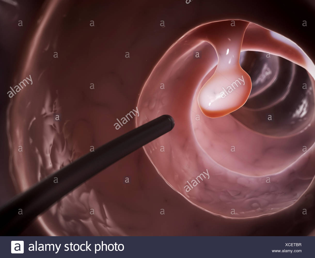 Colonoscopy Illustration High Resolution Stock Photography and Images ...