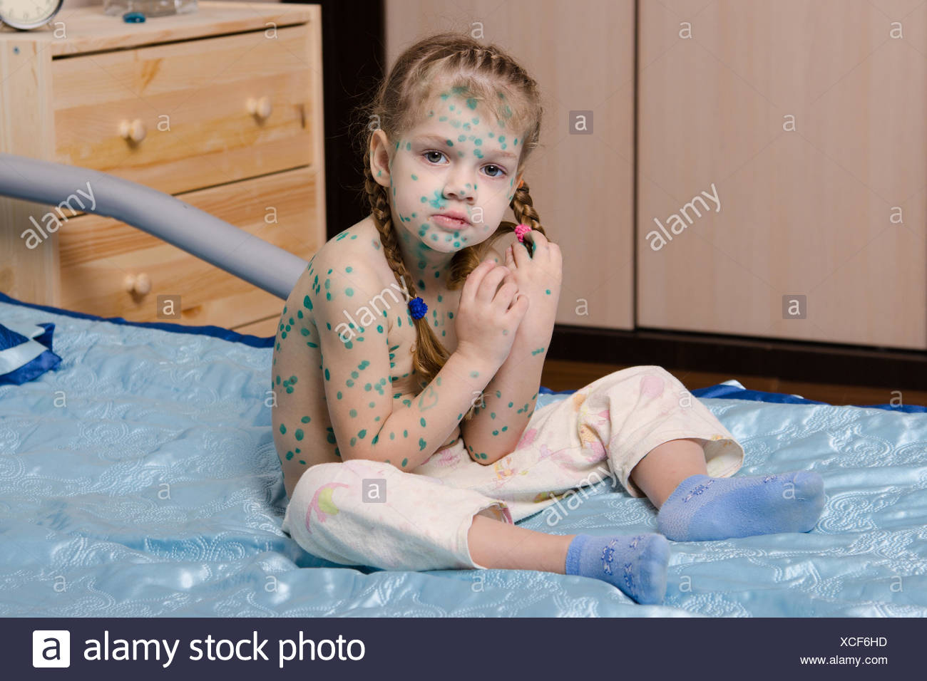 Weeping Skin High Resolution Stock Photography and Images - Alamy