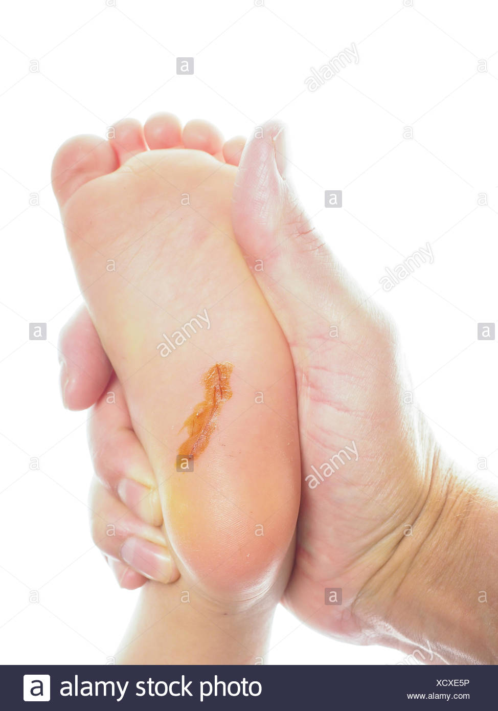 Wound Foot Child High Resolution Stock Photography and Images - Alamy