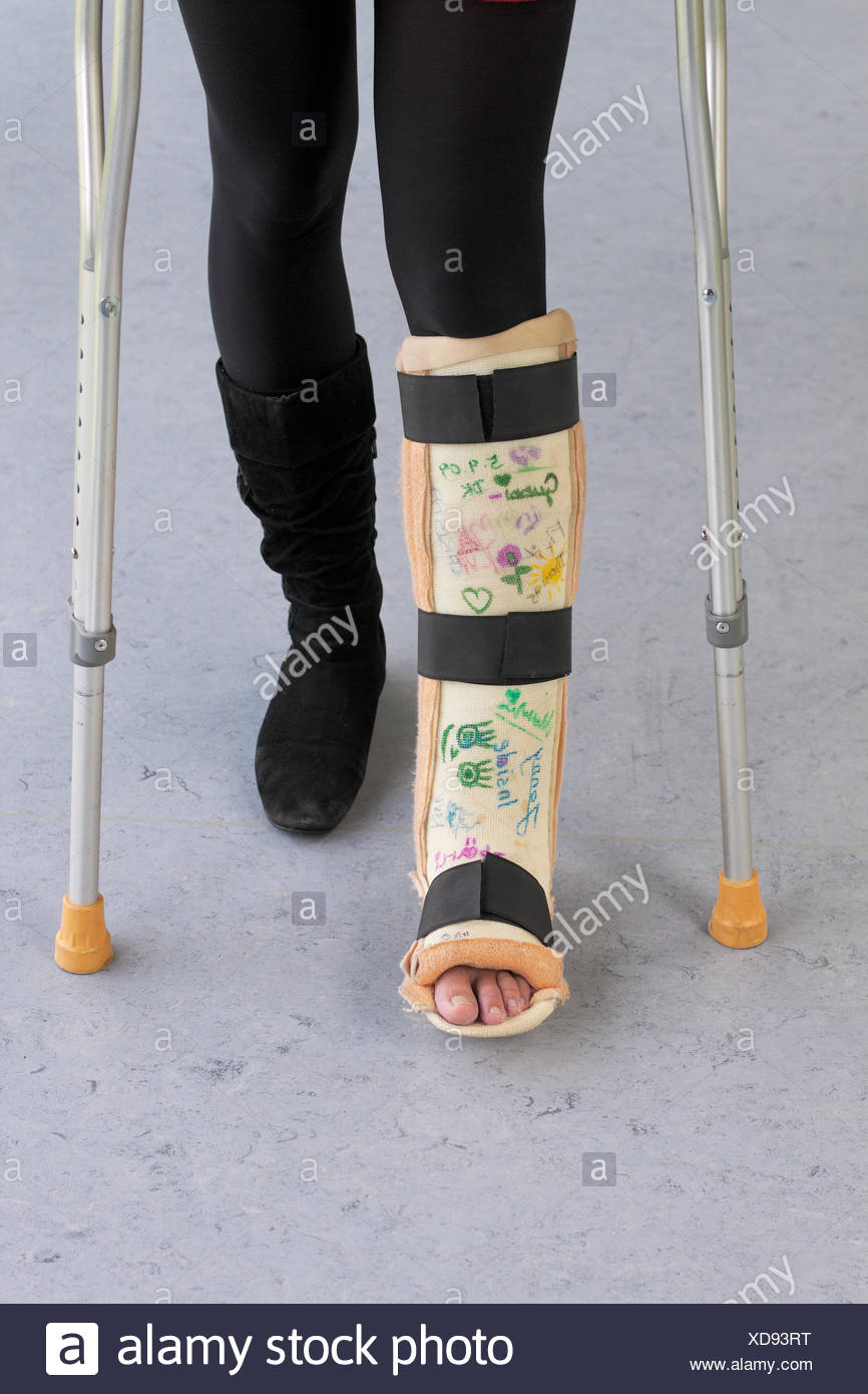 Leg Casts High Resolution Stock Photography and Images - Alamy