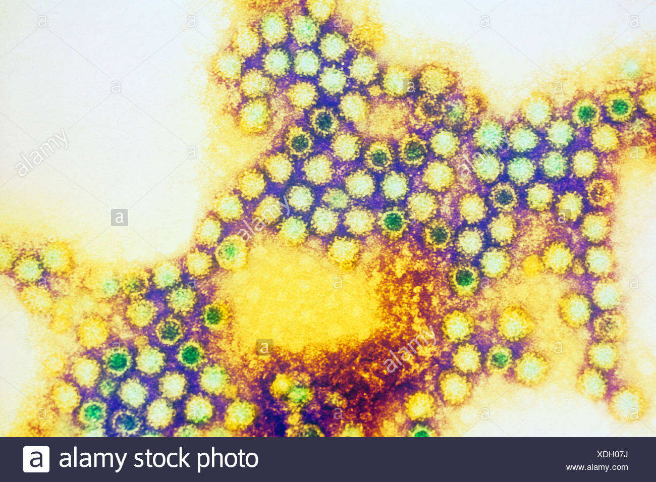 Glossitis High Resolution Stock Photography and Images - Alamy
