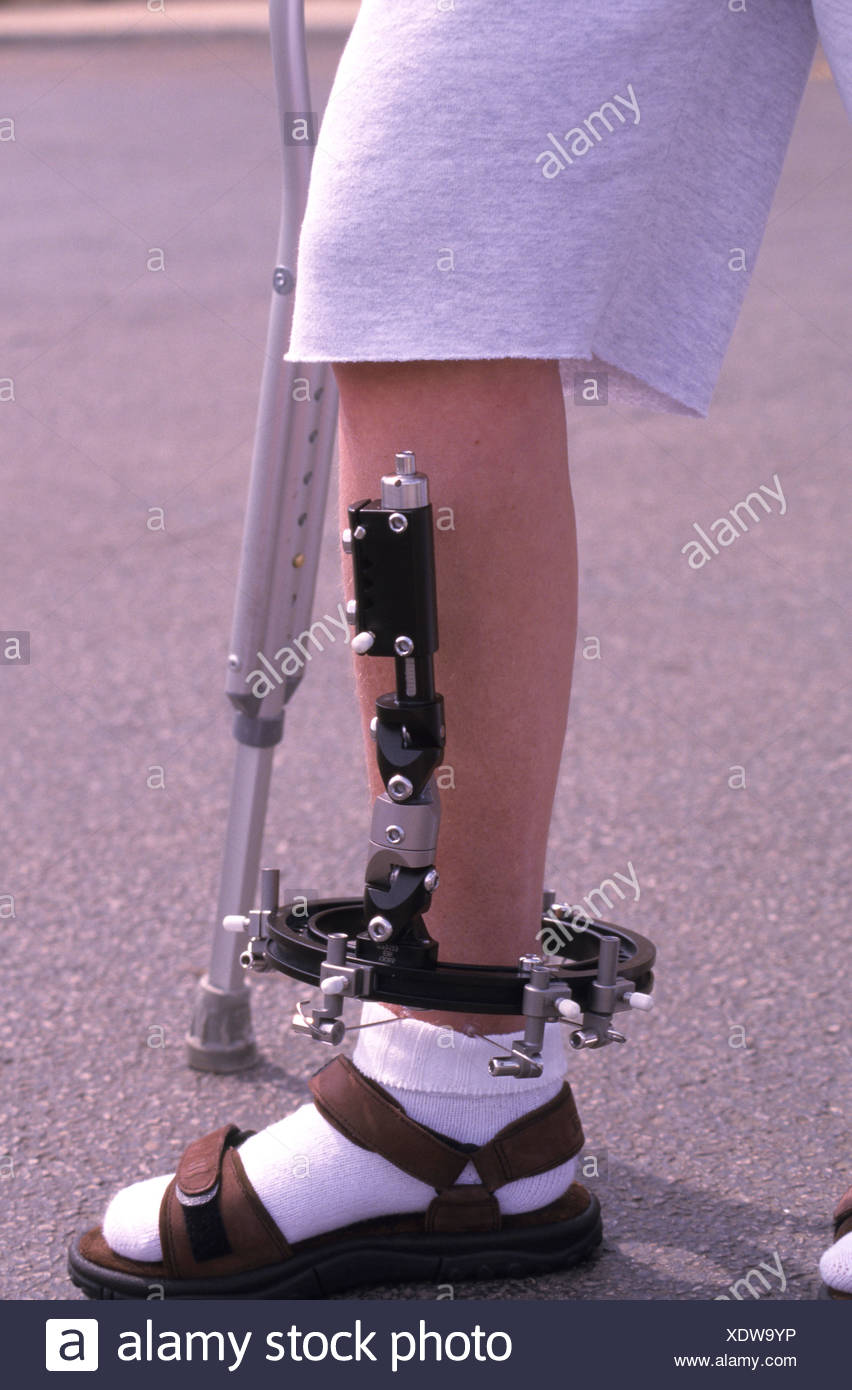 Fixator Stock Photos & Fixator Stock Images - Alamy