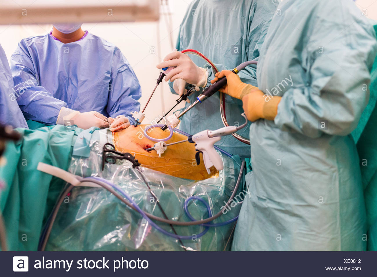 Endometriosis Laparoscopy