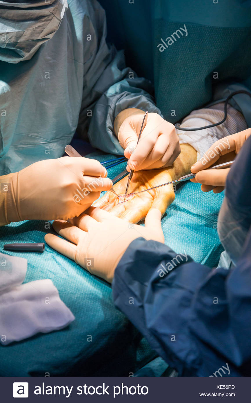 Dupuytrens Contracture Hand Surgery High Resolution Stock Photography ...