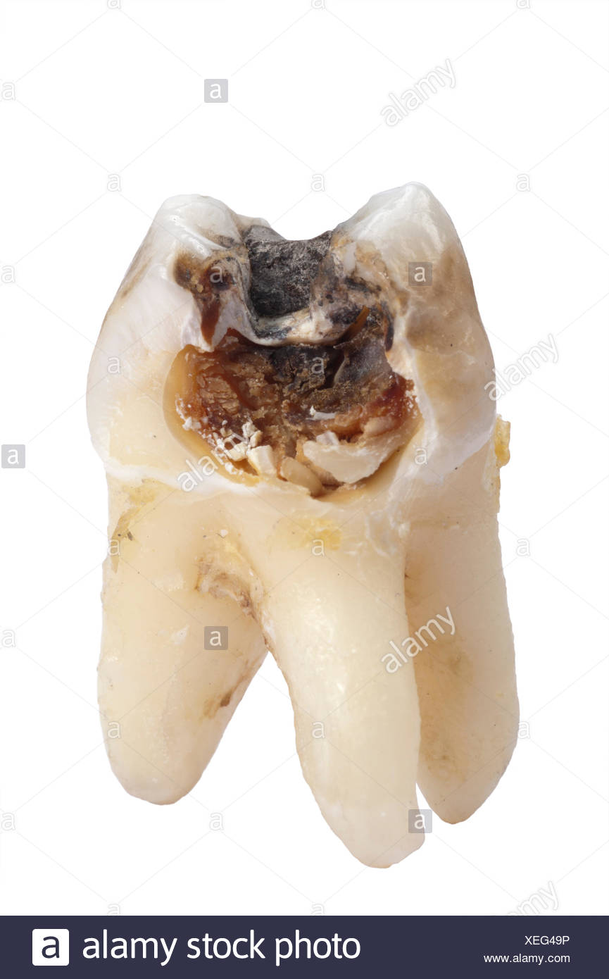 Dental Caries High Resolution Stock Photography and Images - Alamy