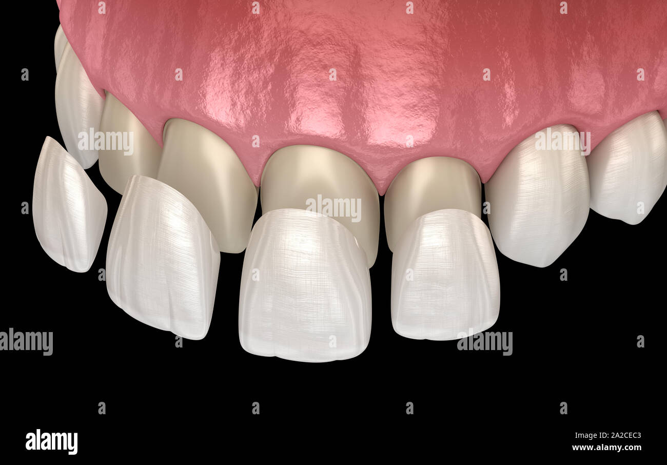 Lateral Incisor Stockfotos und -bilder Kaufen - Alamy