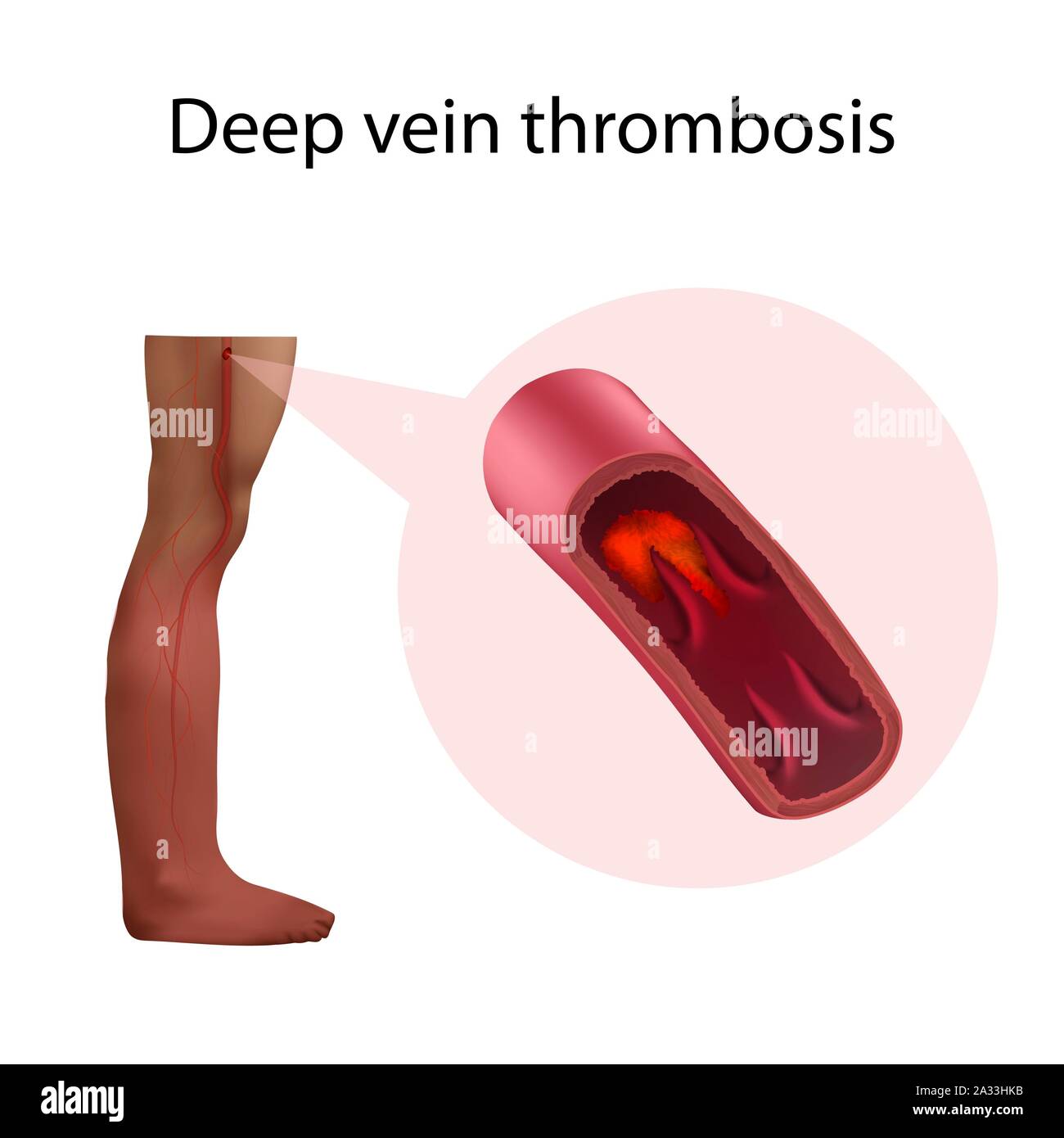 Trombosis venosa profunda -Fotos und -Bildmaterial in hoher Auflösung ...