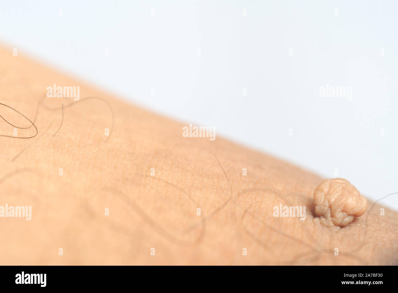 Fibroepithelialer polyp -Fotos und -Bildmaterial in hoher Auflösung – Alamy