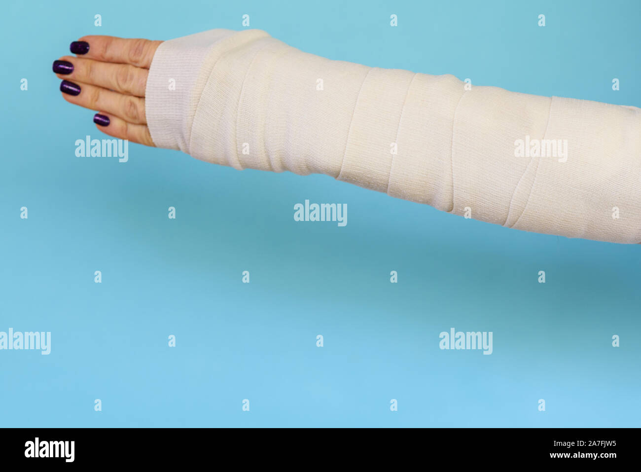 Woman broken arm cast -Fotos und -Bildmaterial in hoher Auflösung – Alamy