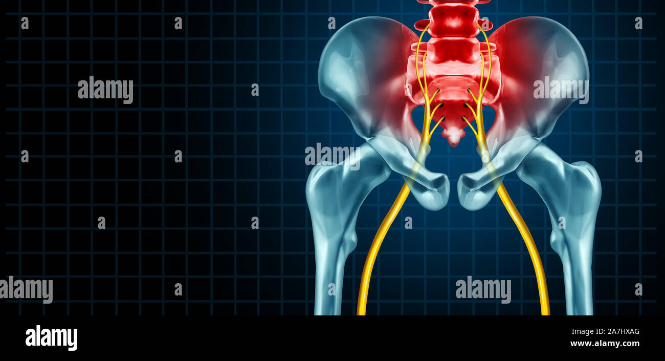 Schmerzhafte Ischiasnerv Symptom und Schmerzen Diagnose als ...