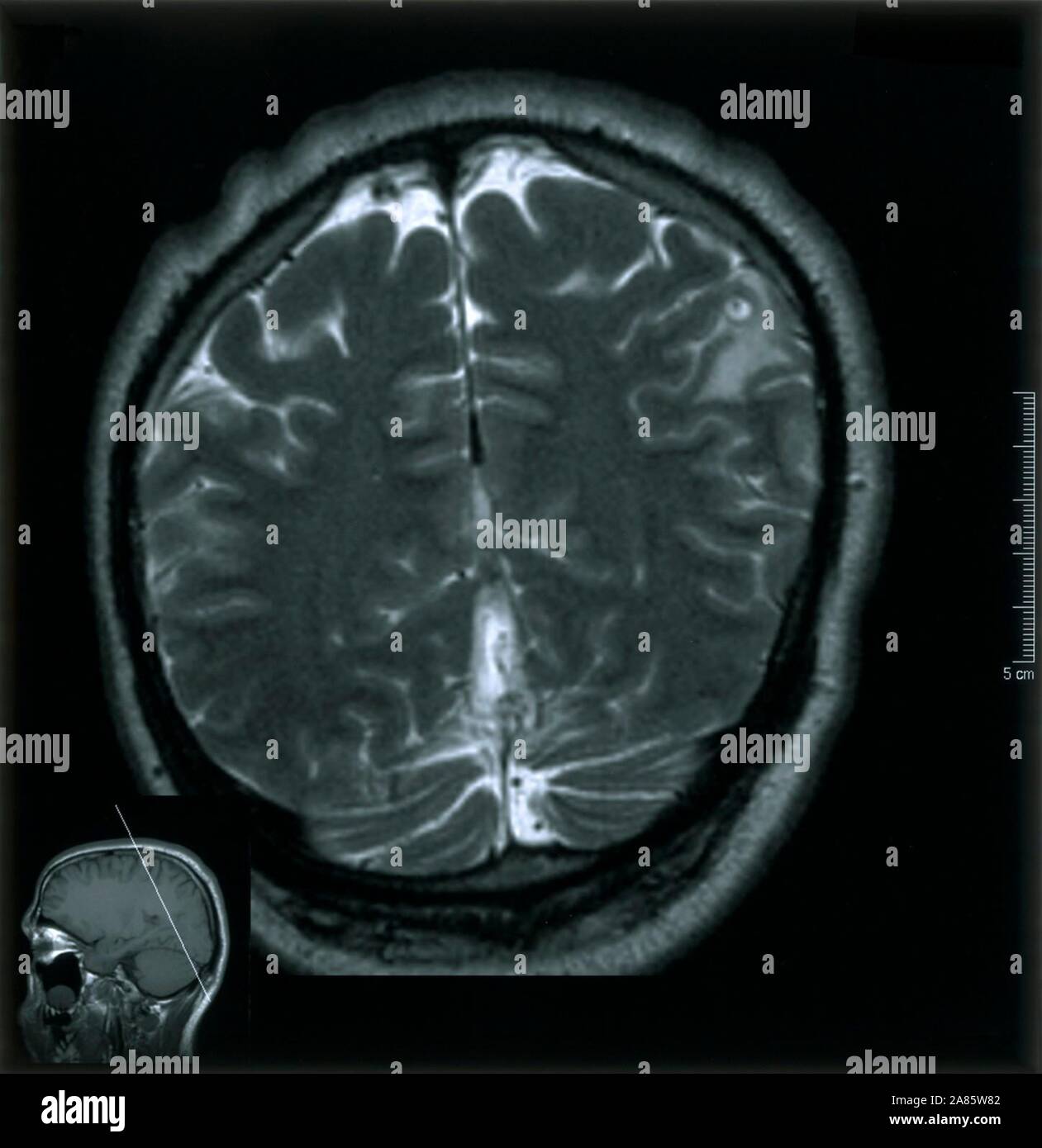 Motorischer Cortex Stockfotos und -bilder Kaufen - Alamy