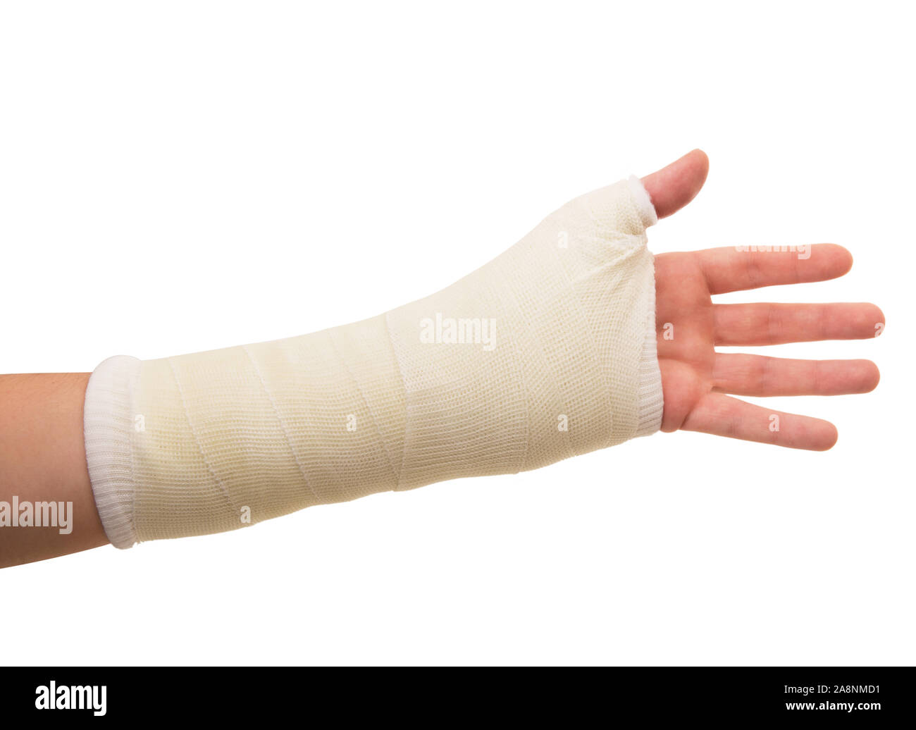 Fracture of the arm Ausgeschnittene Stockfotos und -bilder - Alamy