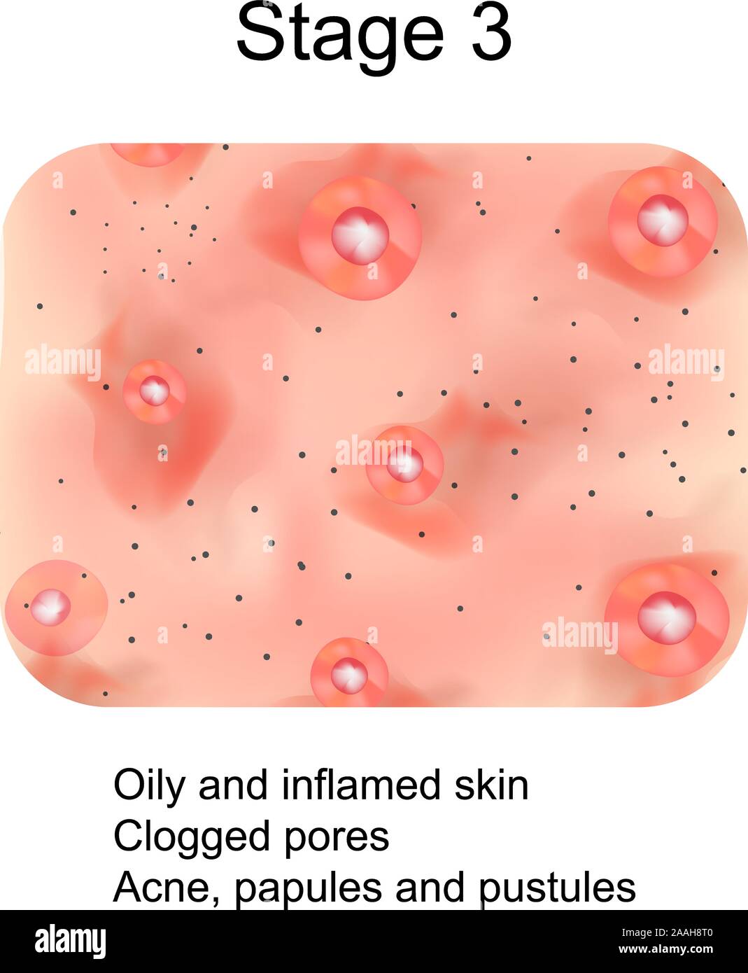 Phase 3 der Entwicklung der Akne. Entzündeter Haut mit Narben, Akne und ...