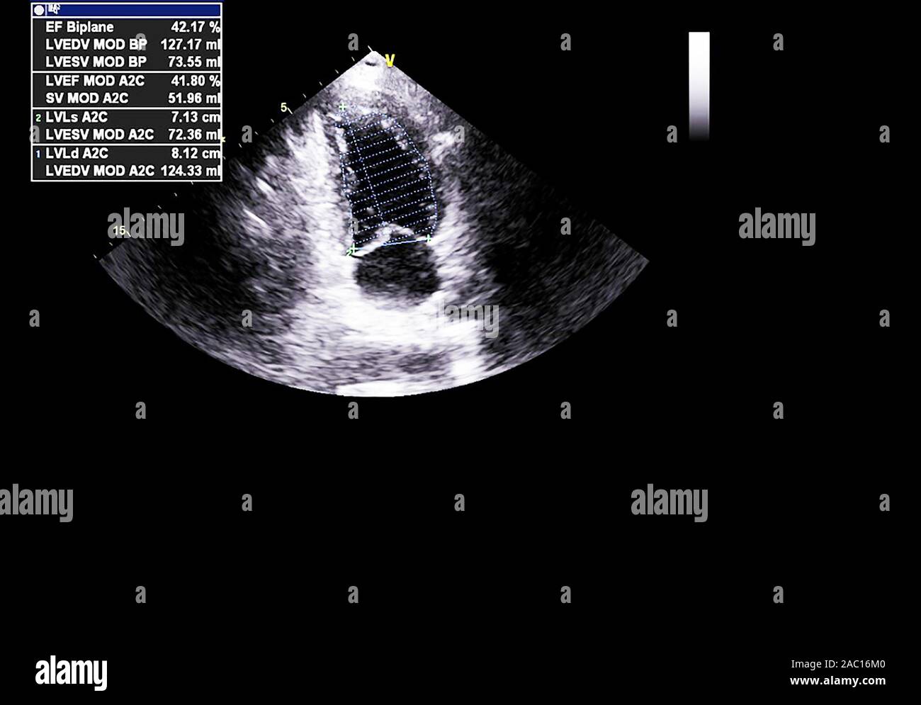Herz ultraschall -Fotos und -Bildmaterial in hoher Auflösung – Alamy