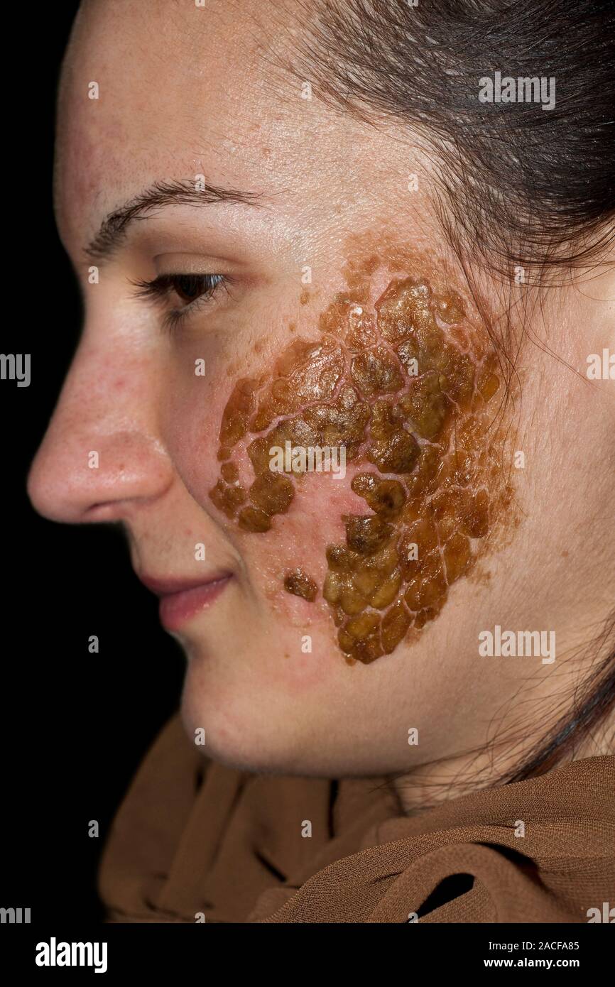 Behandlung von Aknenarben. Getrocknete Kruste auf die Wange einer Frau ...