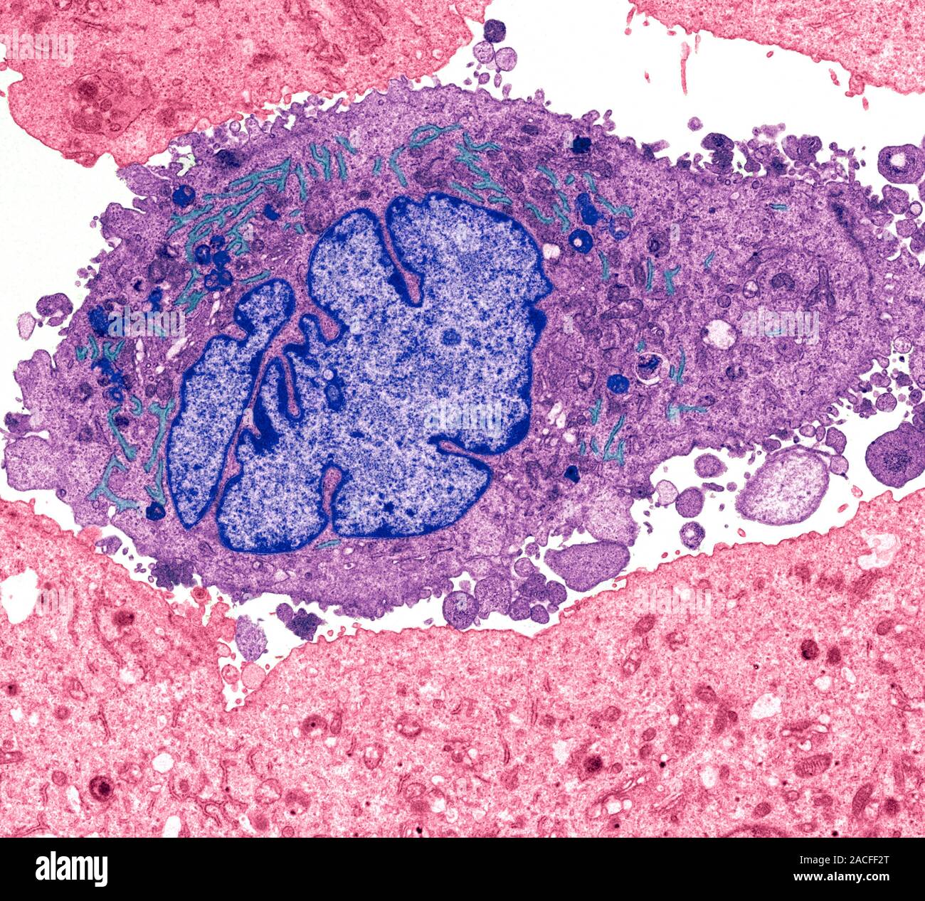 Lungenkrebs Zelle, farbige Transmission Electron Micrograph (TEM ...