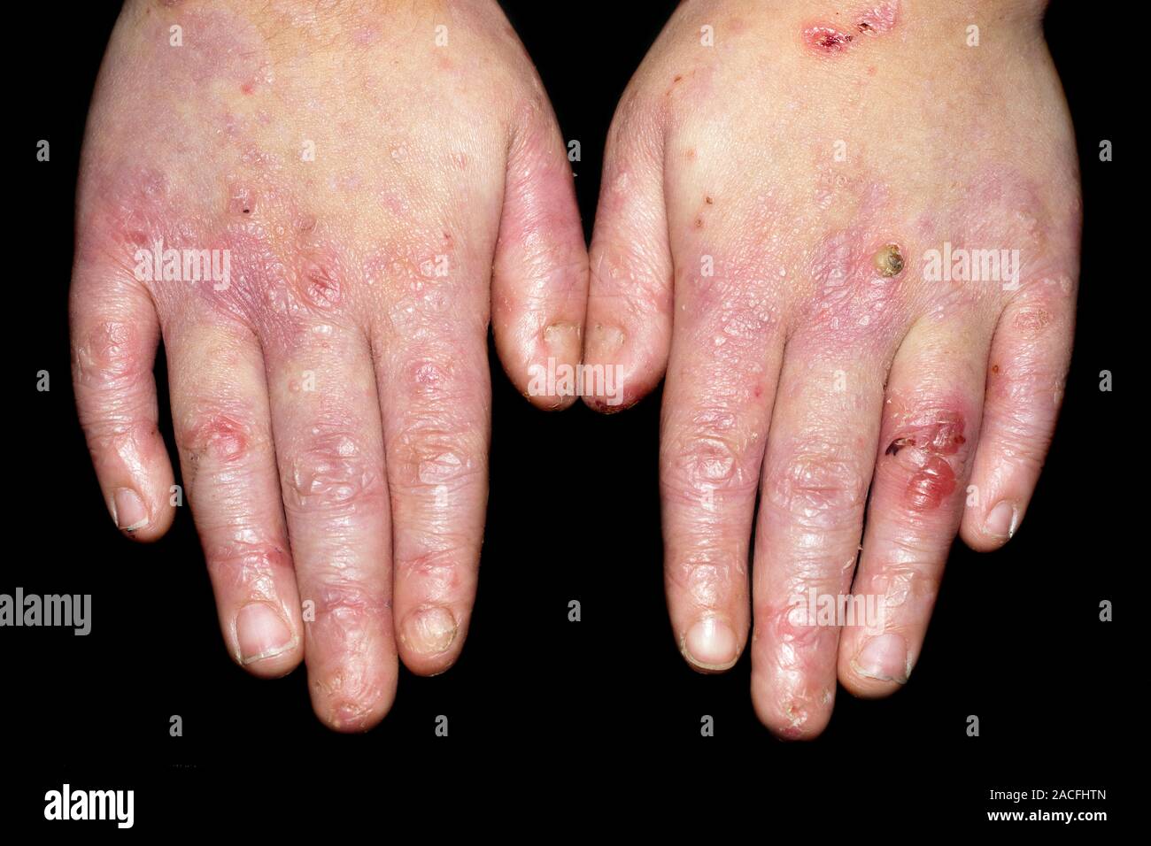 Epidermolysis bullosa. Hände von einem fünf Jahre alten Mädchen mit ...