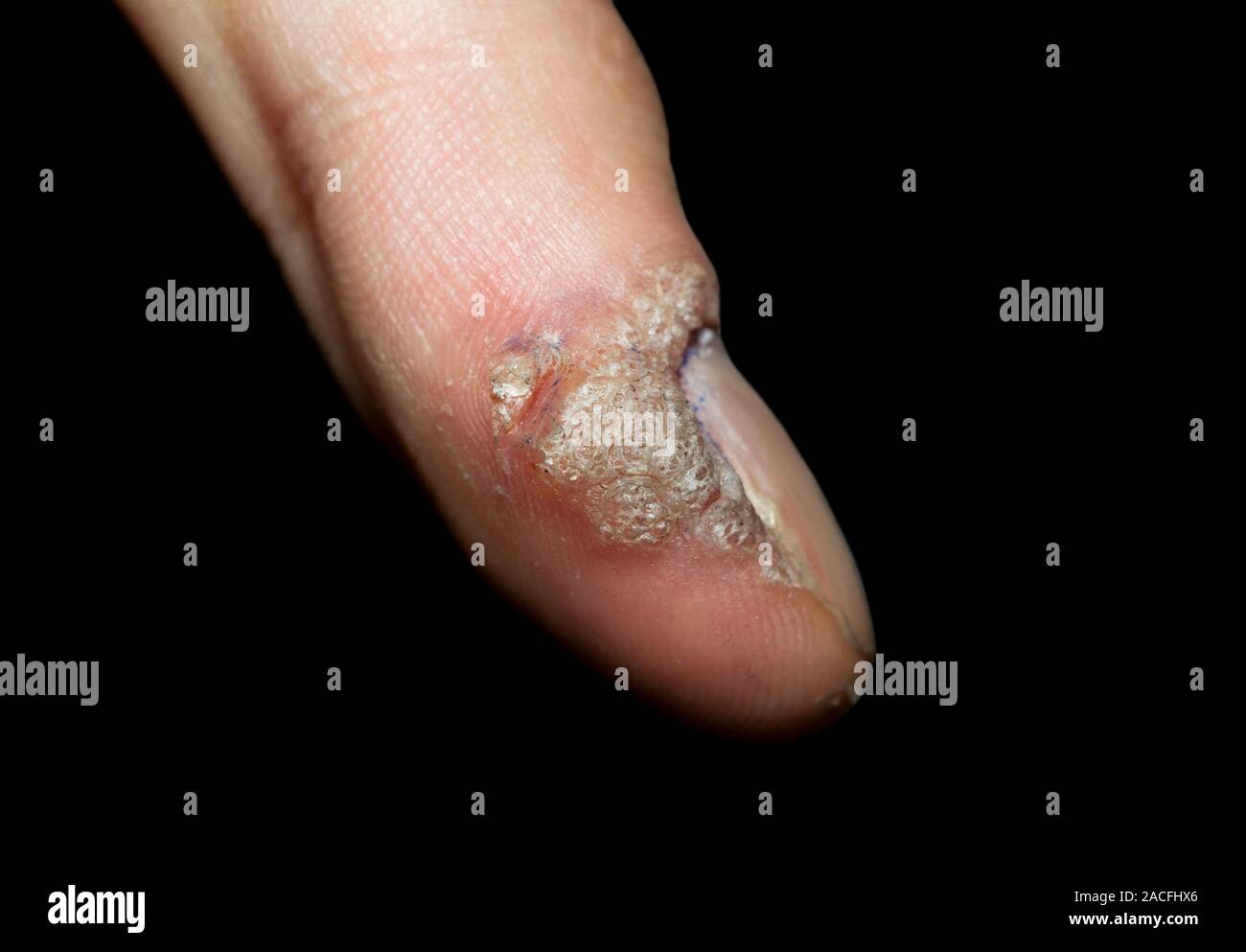 Gemeinsame Warzen auf den Finger des Patienten. Warzen sind ansteckend ...