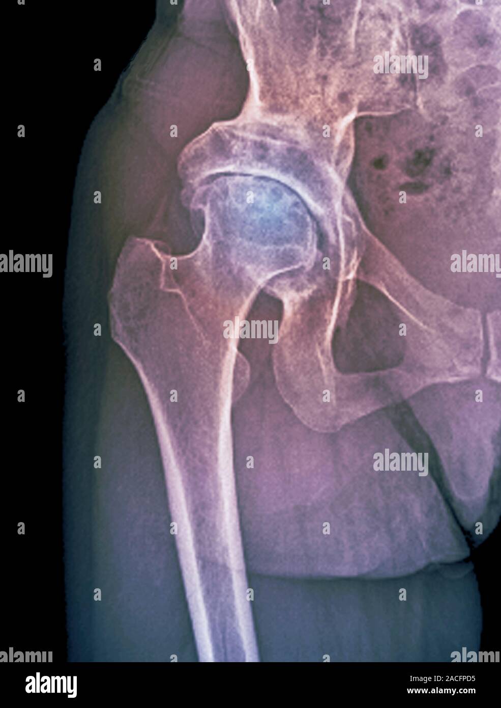 Farbige X-ray von der Hüfte des Patienten im Alter von 54 mit ...