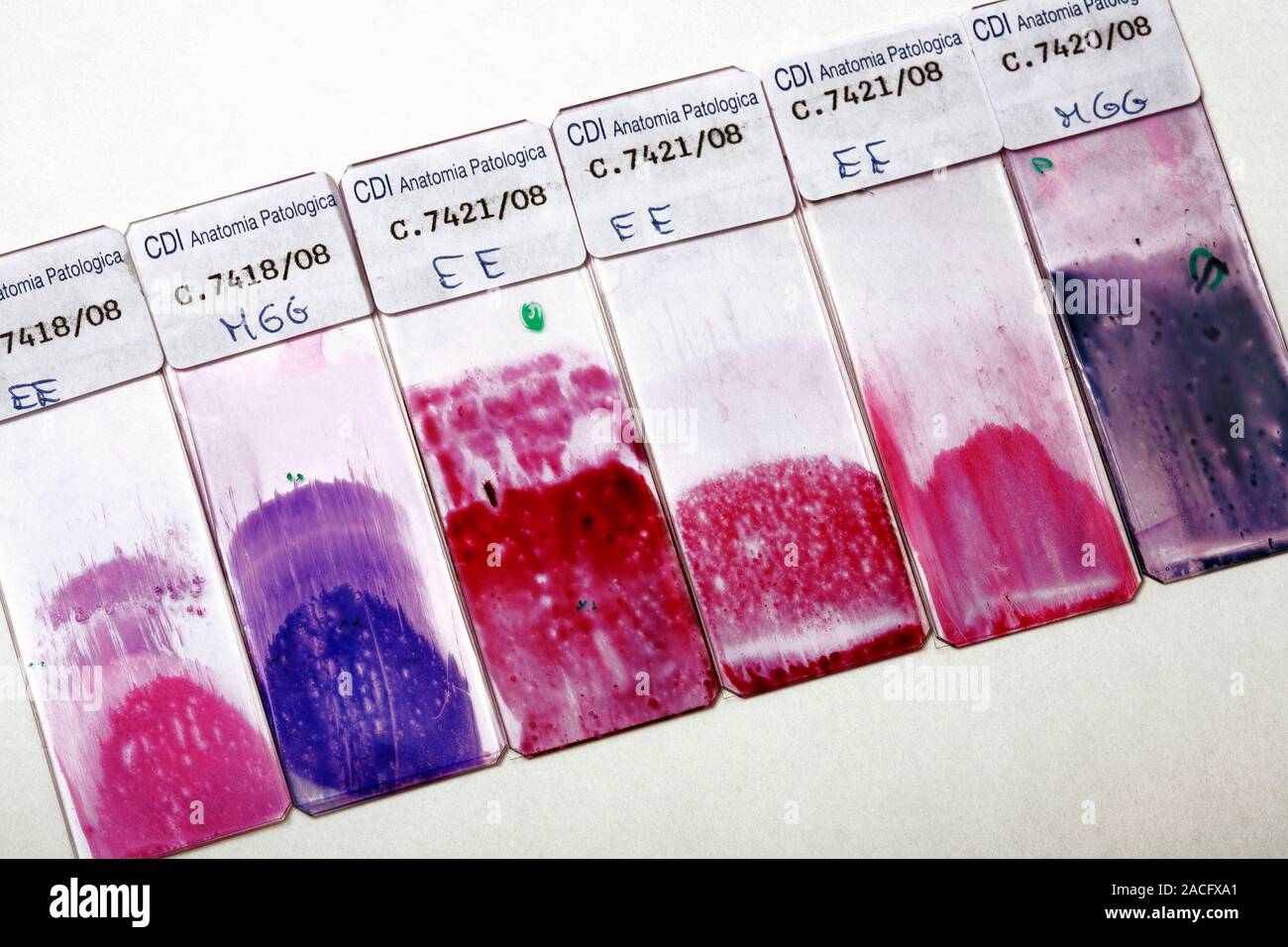 Abstrich Folien. Zeile der gefärbten Abstrich histologischer Präparate ...
