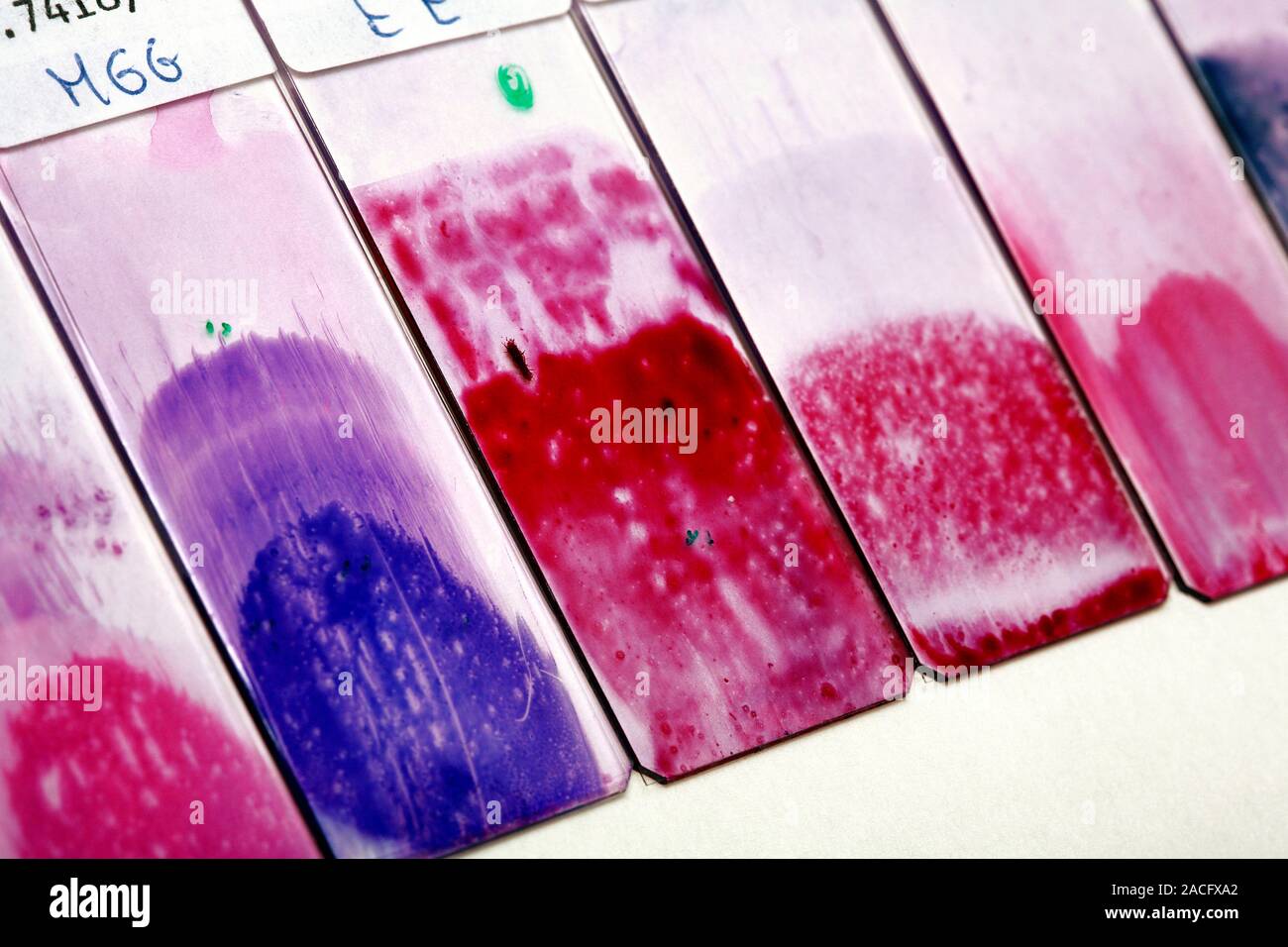 Abstrich Folien. Zeile der gefärbten Abstrich histologischer Präparate ...