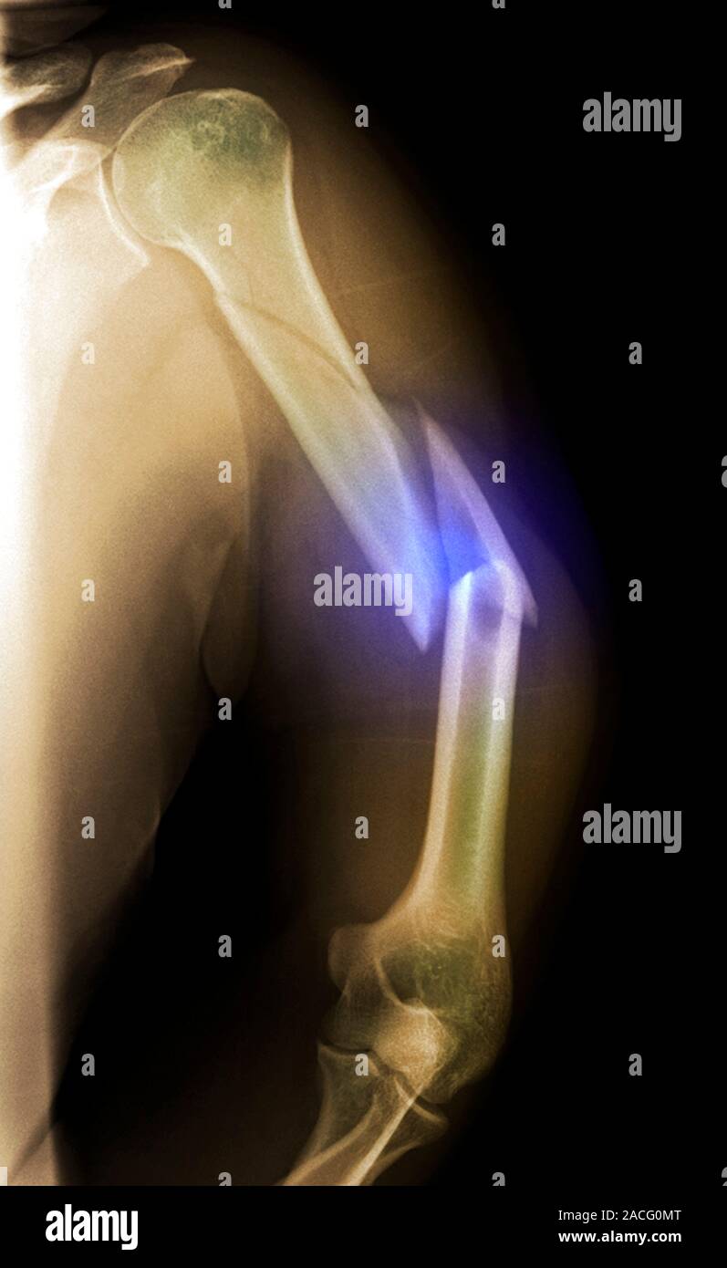 Farbige X-Ray (Vorderansicht) der Arm des Patienten und zeigt eine ...
