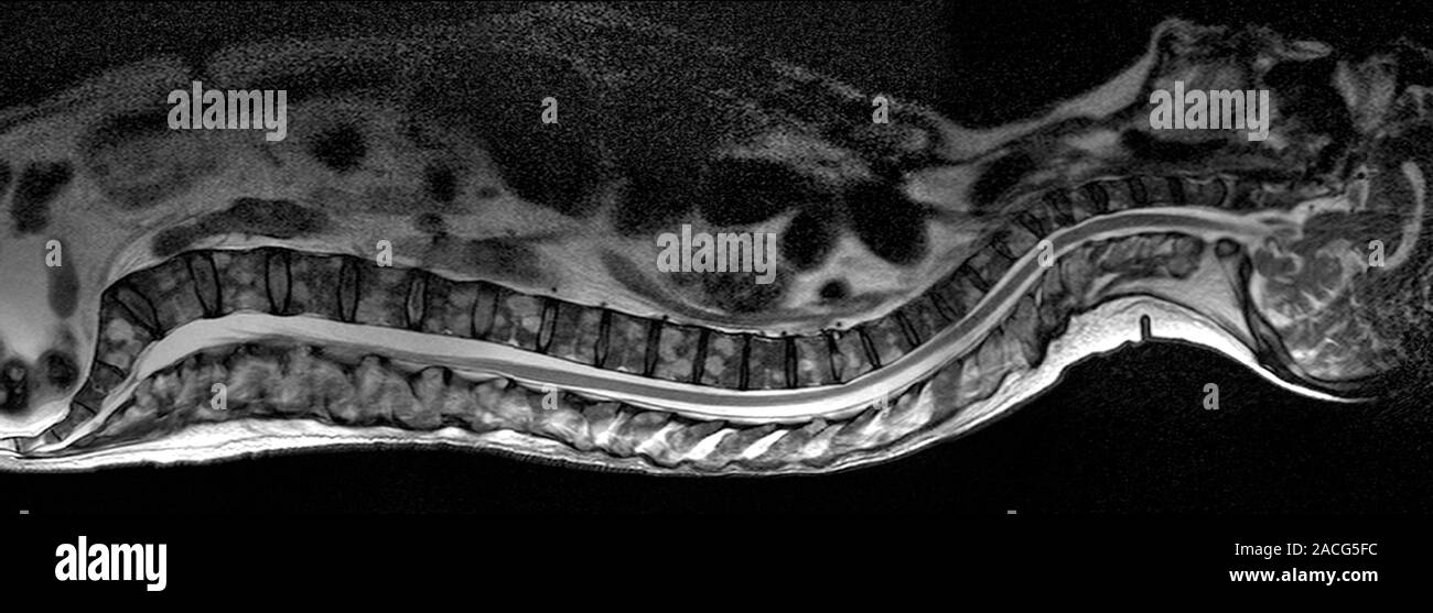 Knochenmark Krebs. Die Magnetresonanztomographie (MRT) Scan zeigt einen ...