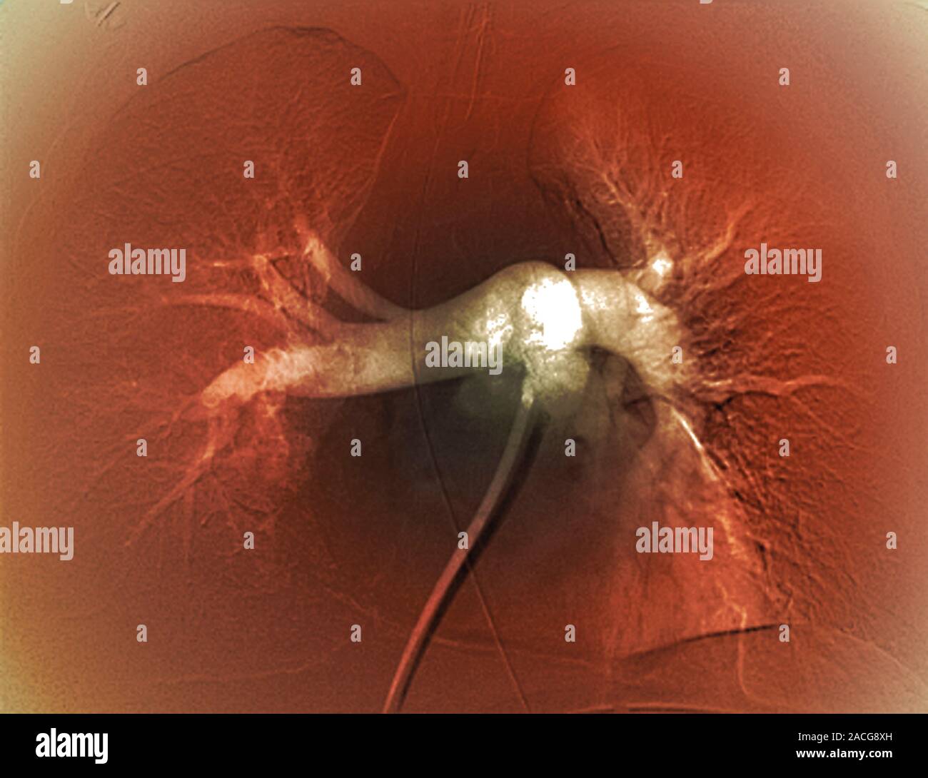 Farbige digitalisierte pulmonale Angiographie (X-ray) in der ...