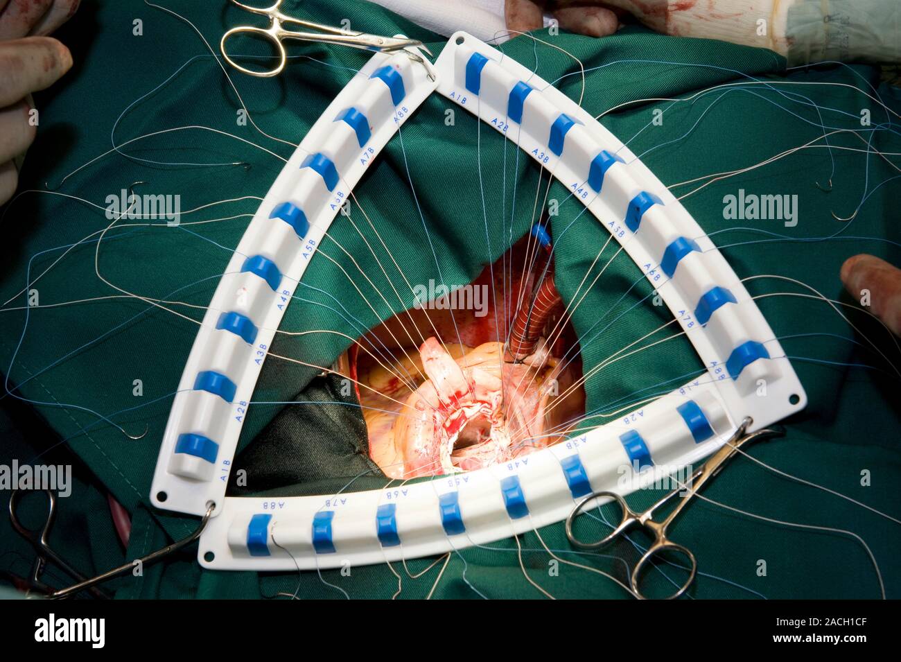 Aorta Chirurgie. Gestrickt für einen Ersatz der Aorta arterie an der ...