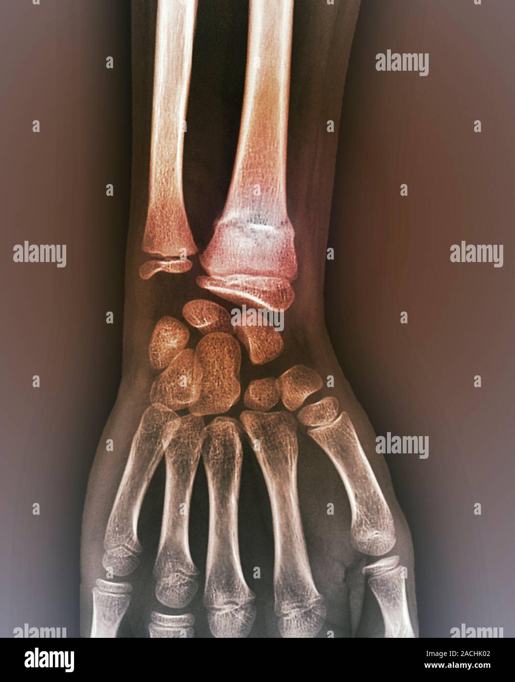Geheilt arm Knochenbruch. Farbige X-ray von Handgelenk und Unterarm ...