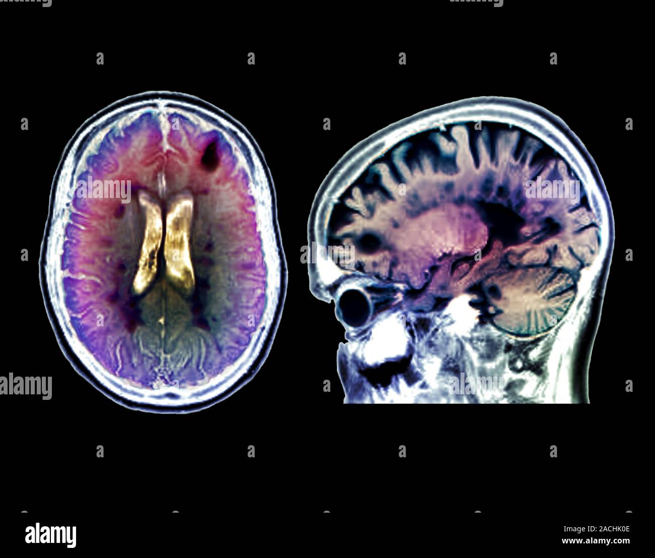 Pyramidale Brain Syndrom. Axialen und sagittalen farbige Magnetresonanztomographie (MRT) Scans ...