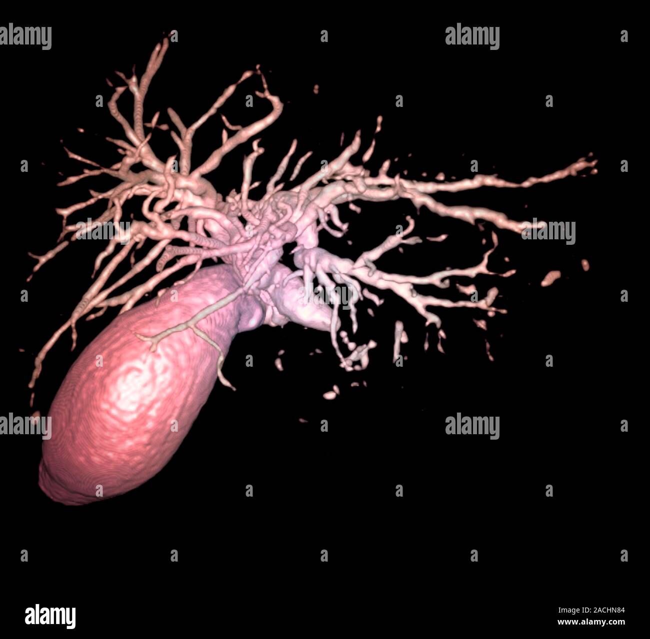 Gallenblase und Gallenwege. Drei-dimensional Magnetic Resonance Image ...