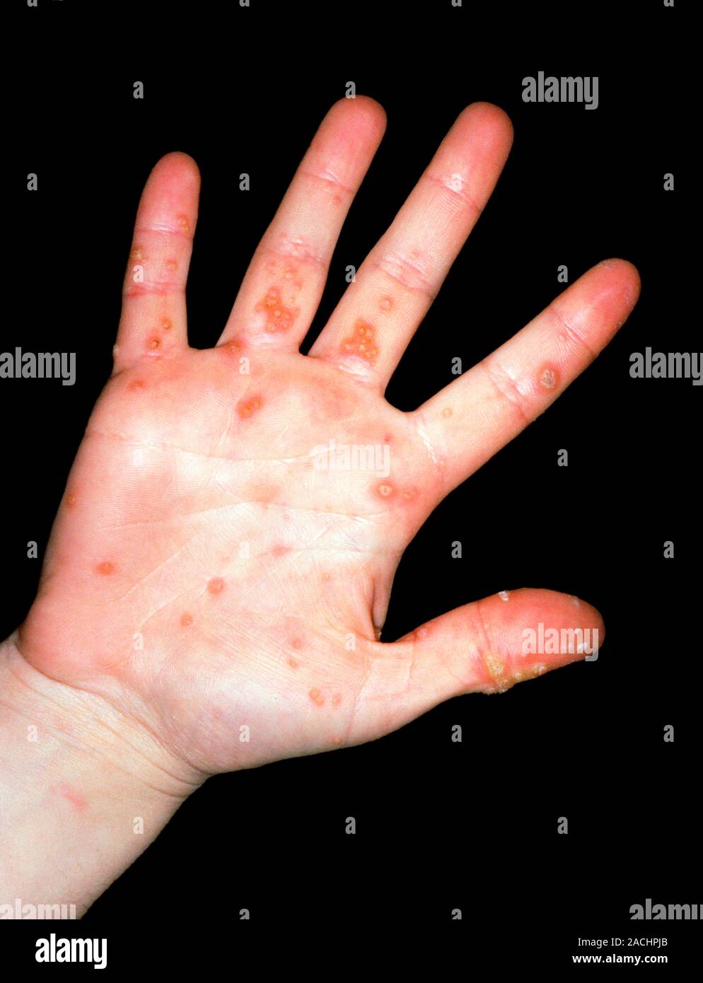 Allgemeine Warzen (Verruca vulgaris) auf der Handfläche des Patienten ...